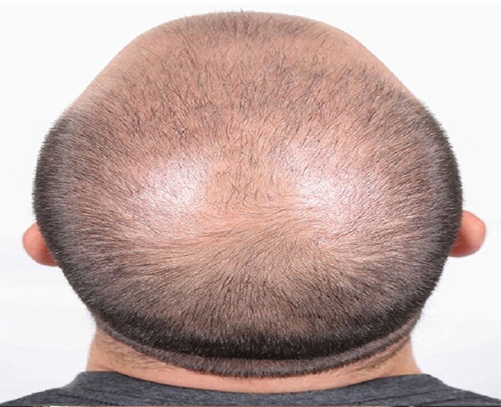 Before & After – Bio Aesthetics